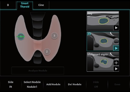 Smart Thyroid - Софтуер за ехограф Mindray | Infinita_BG